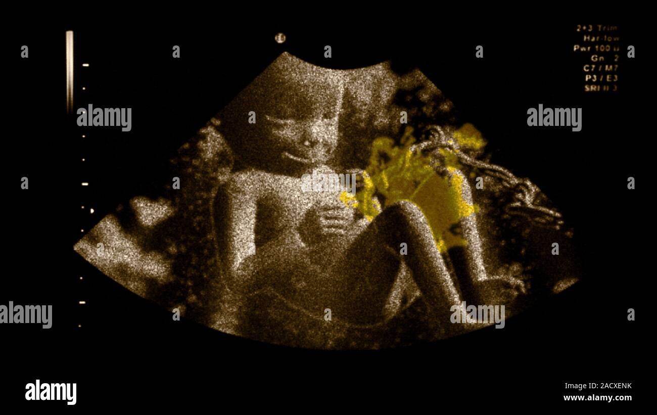 Artwork of a 3D ultrasound scan showing a foetus in the womb. The ...