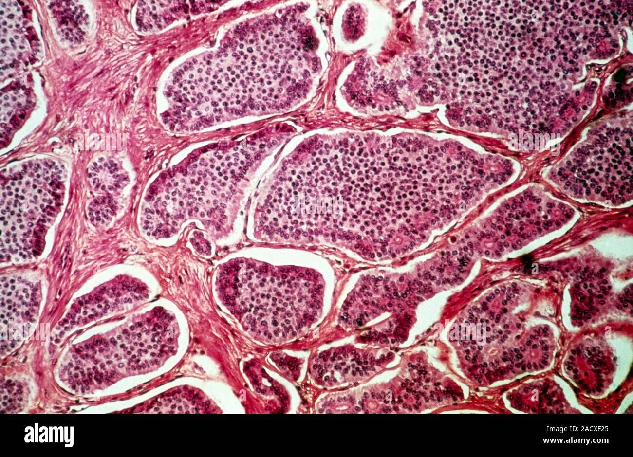 Intestinal cancer, light micrograph. This is a section of a malignant ...