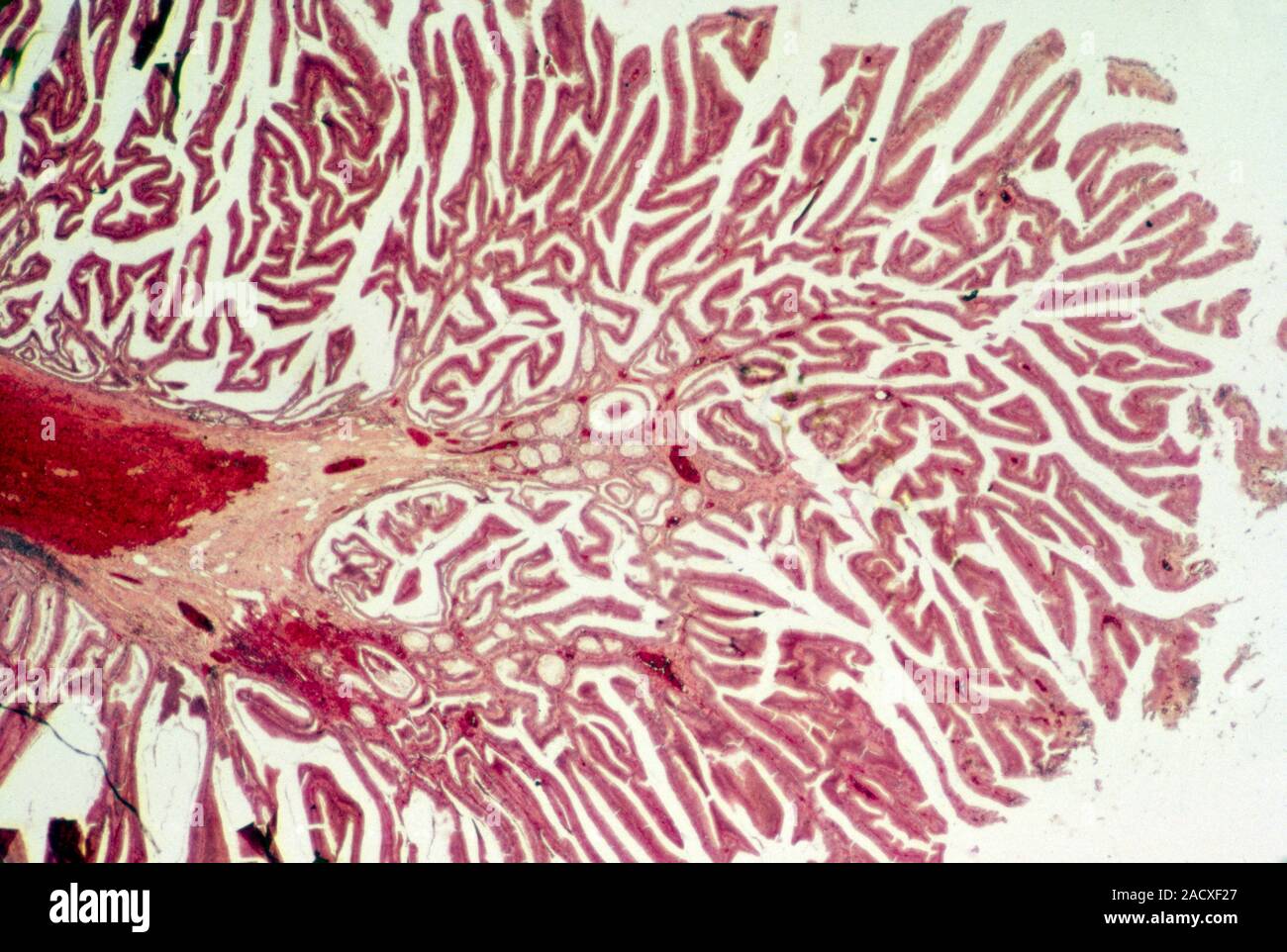 Rectal Tumour Light Micrograph Section Of A Villous Adenoma A Benign