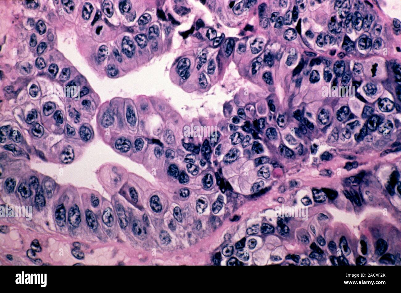 Stomach cancer, light micrograph. Section of tissue from a gastric ...