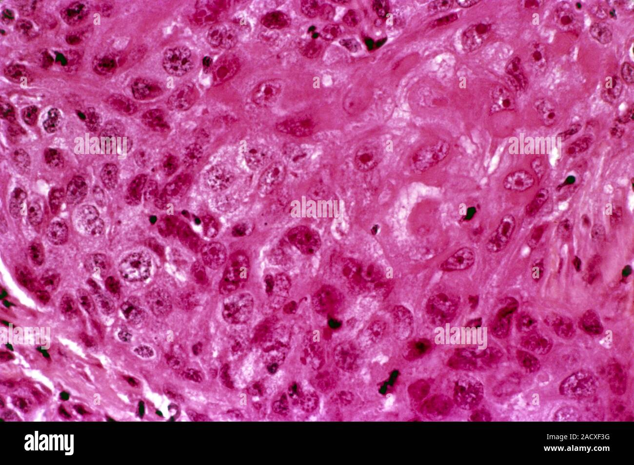 Oesophageal cancer. Light micrograph of a section through a carcinoma ...