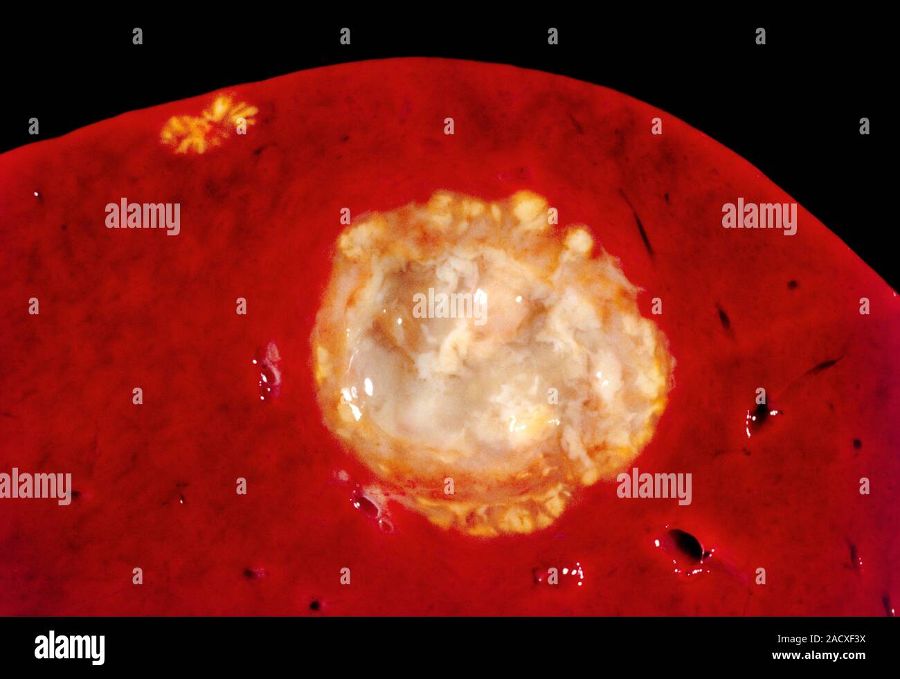 Liver abscess, gross specimen. A liver abscess is a pus-filled cavity ...