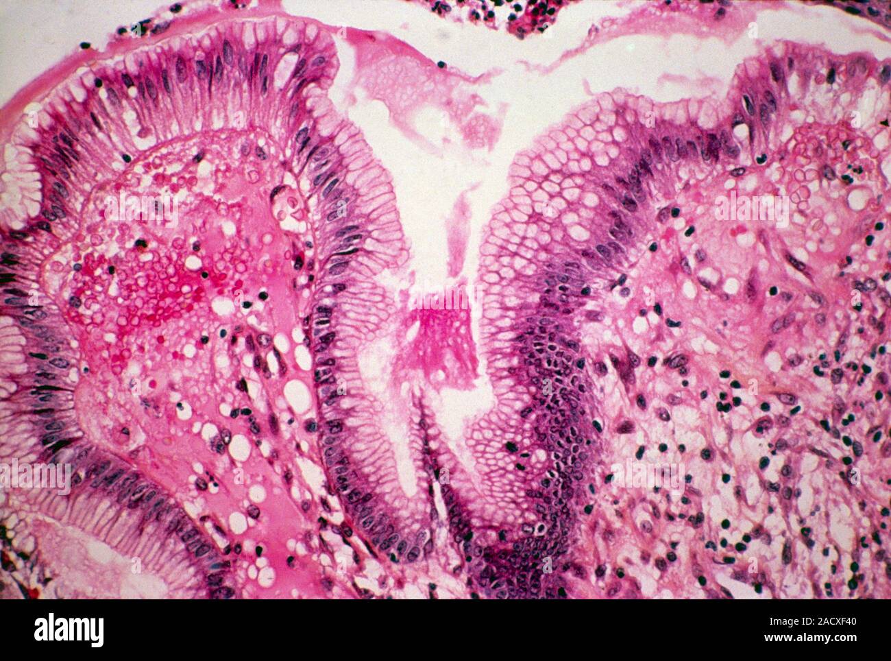 Stomach ulcer. Light micrograph of a gastric (stomach) ulcer. The ...