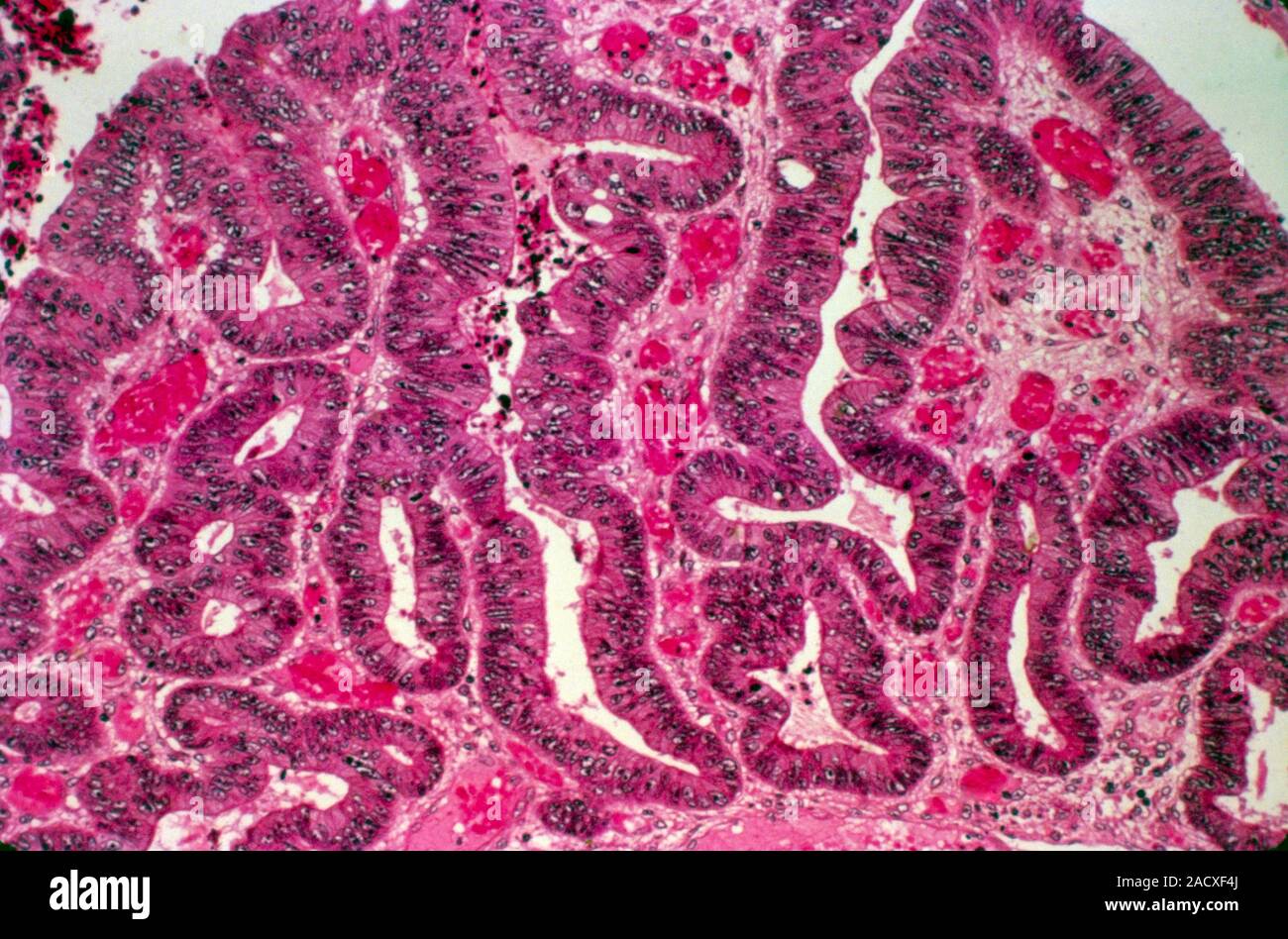 Colon cancer. Light micrograph of a section through an adenocarcinoma ...