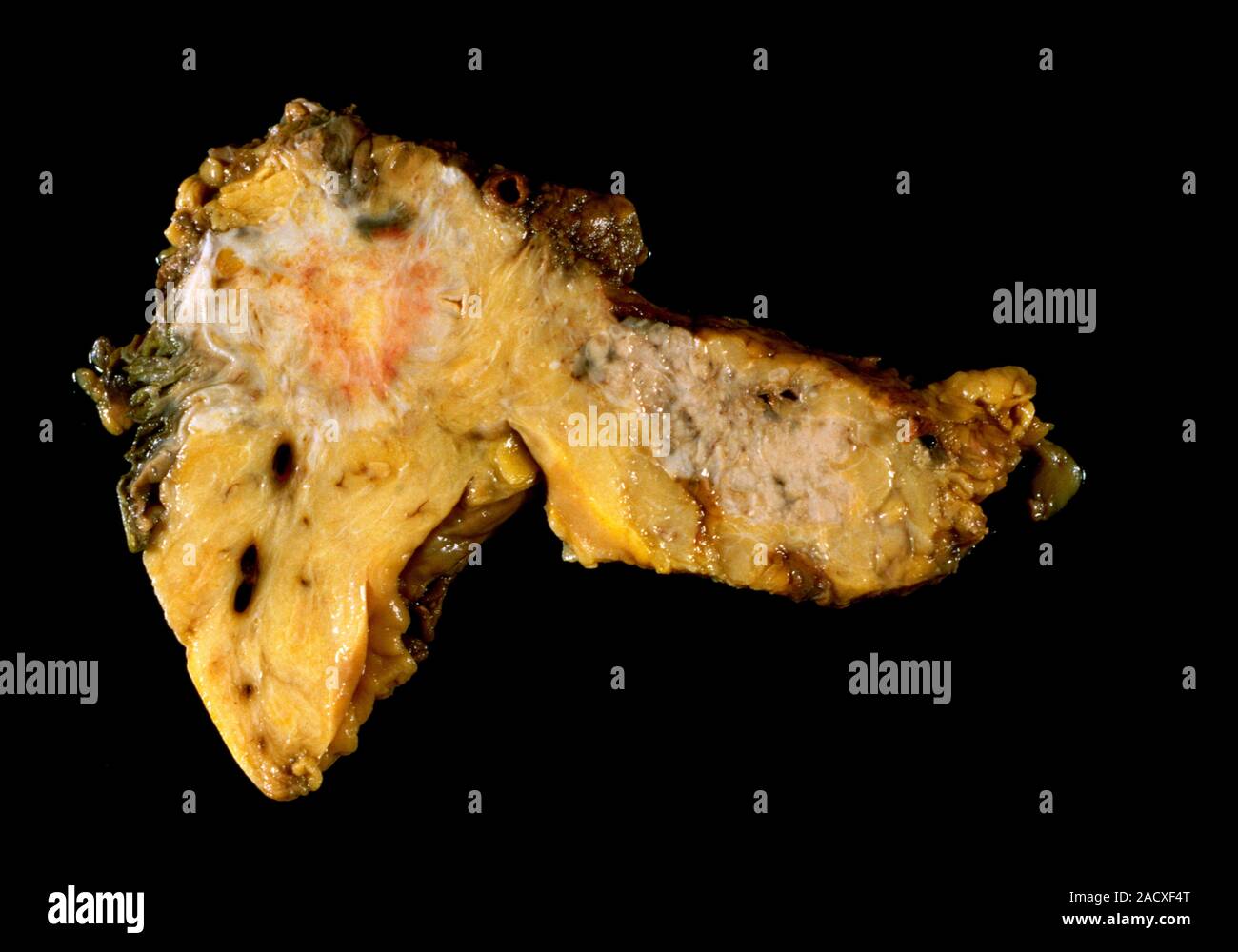 Pancreatic cancer, gross specimen. Large, malignant (cancerous) tumours ...