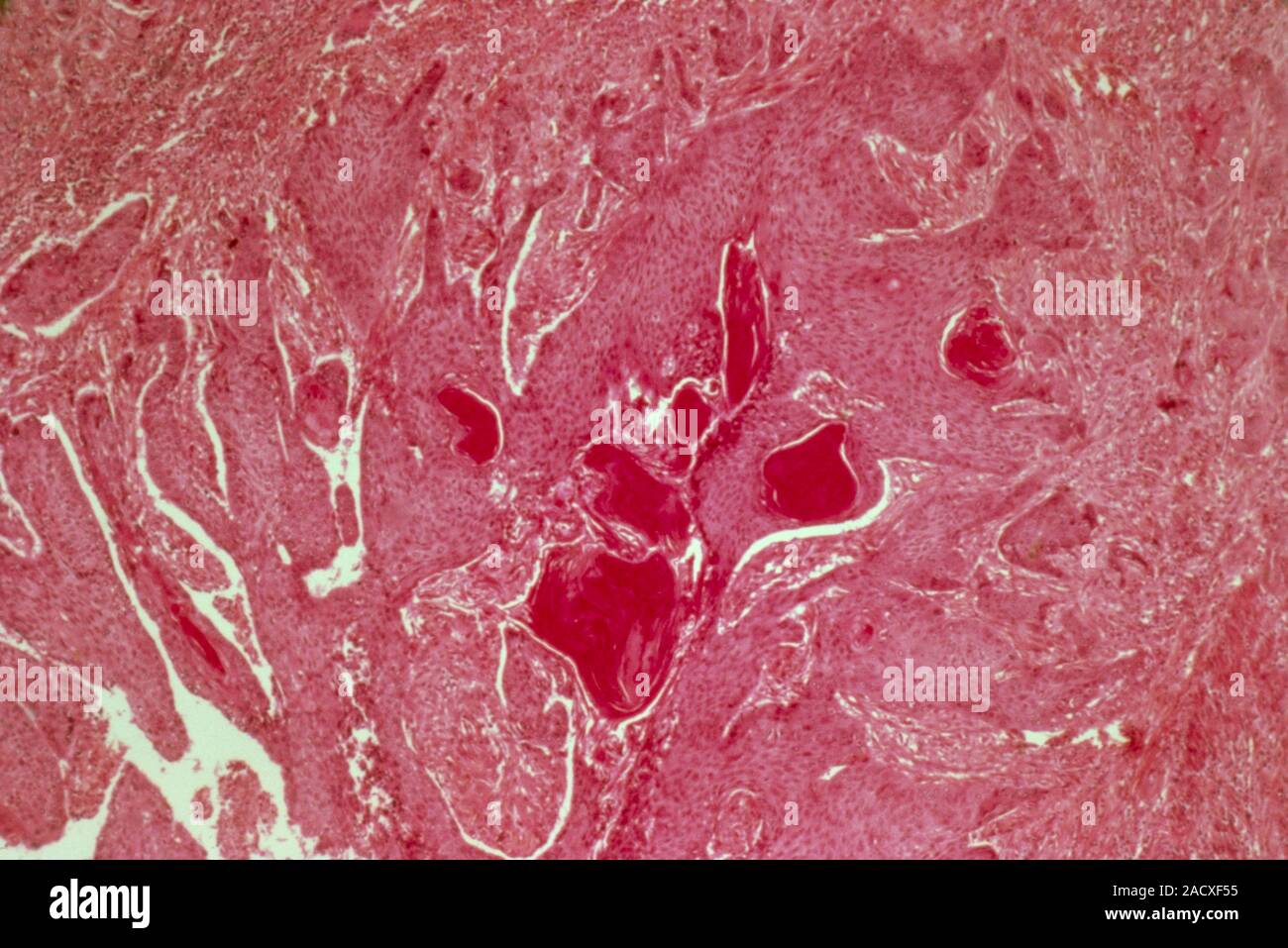 Oesophageal cancer. Light micrograph of a section through a carcinoma ...