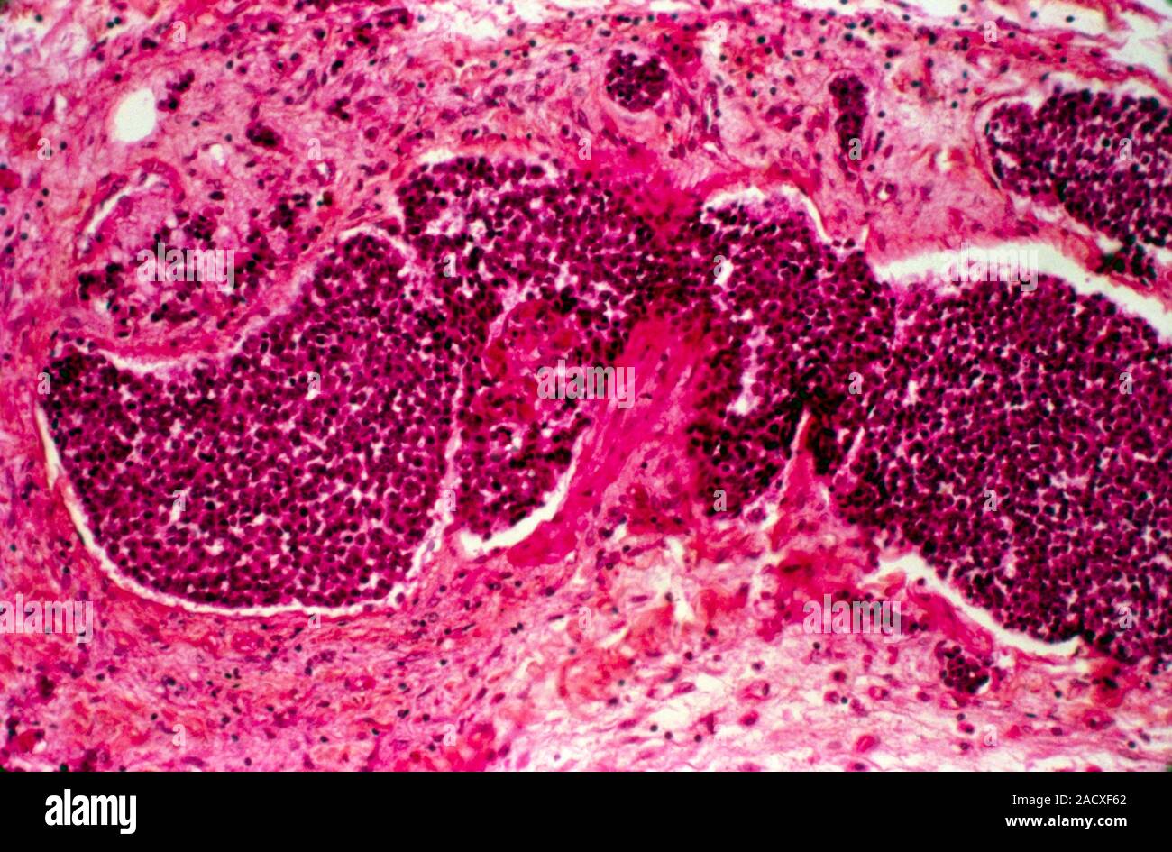 Pancreatic cancer. Light micrograph of a section from a pancreatic ...