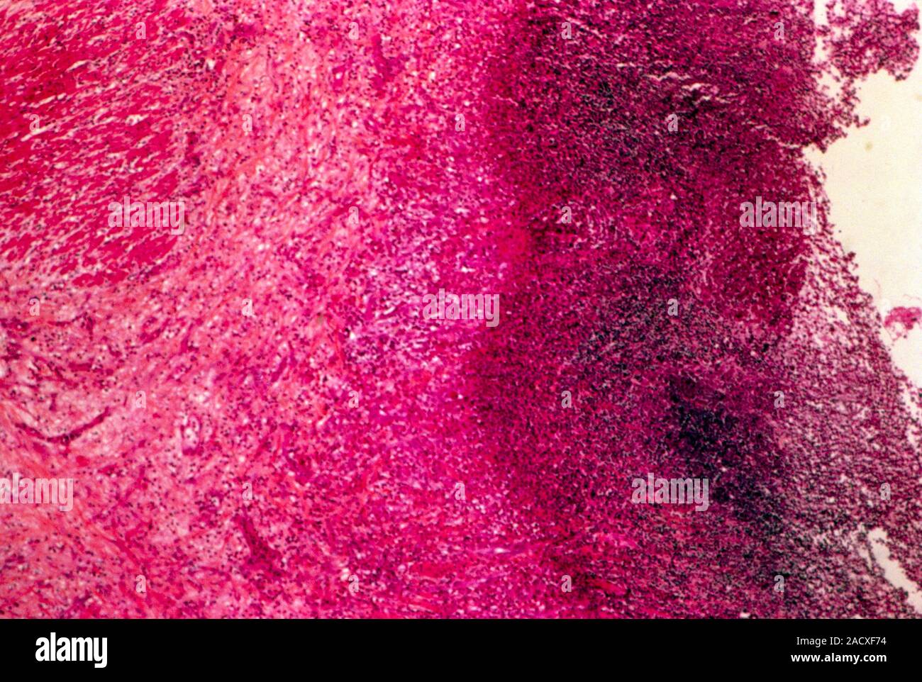 Stomach ulcer. Light micrograph of a gastric (stomach) ulcer. The ...
