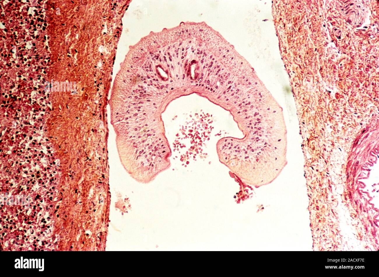 Schistosome parasite in the liver. Light micrograph of liver tissue ...