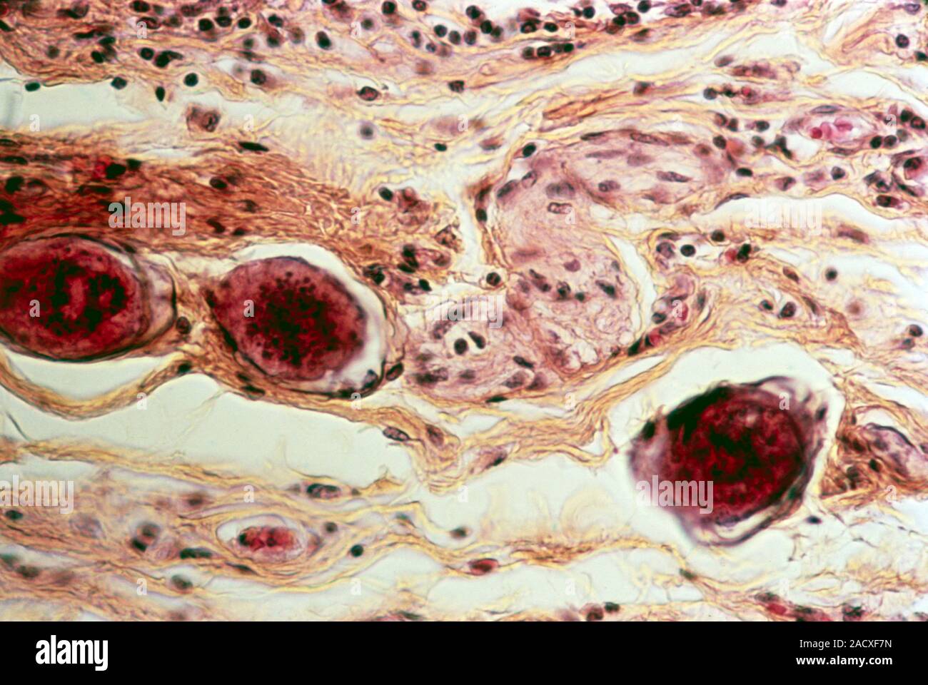 Schistosome parasite eggs in the large intestine. Light micrograph of ...