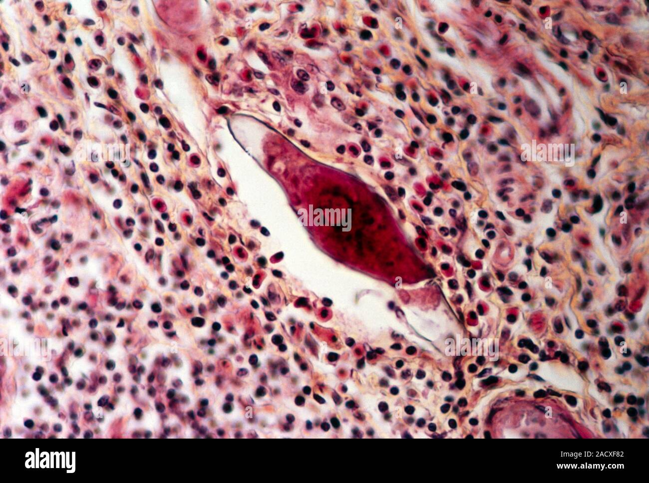 Schistosome parasite in the rectum. Light micrograph of rectal tissue ...
