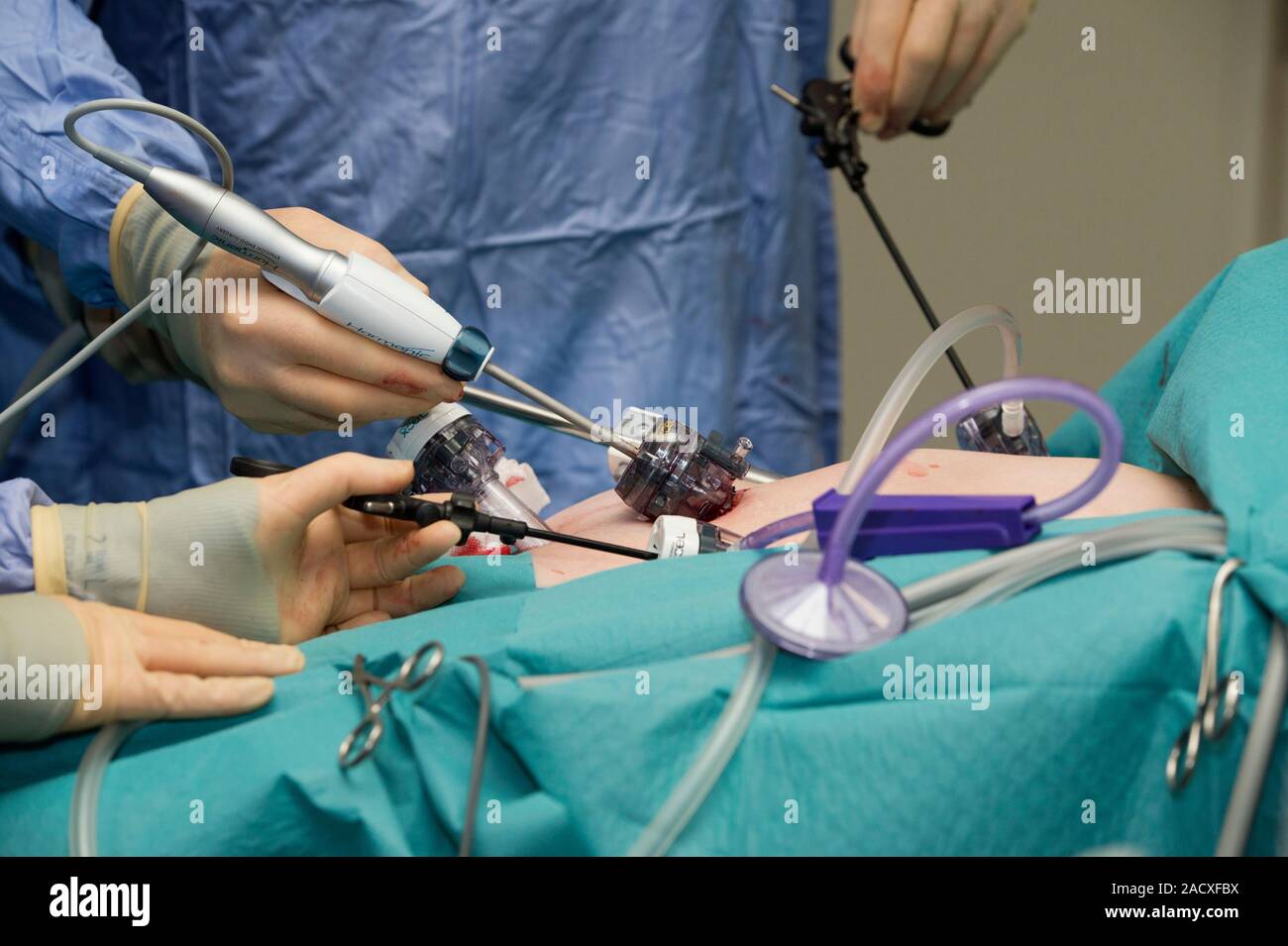 Three dimensional laparoscopic surgery. Laparoscopic surgery, also ...