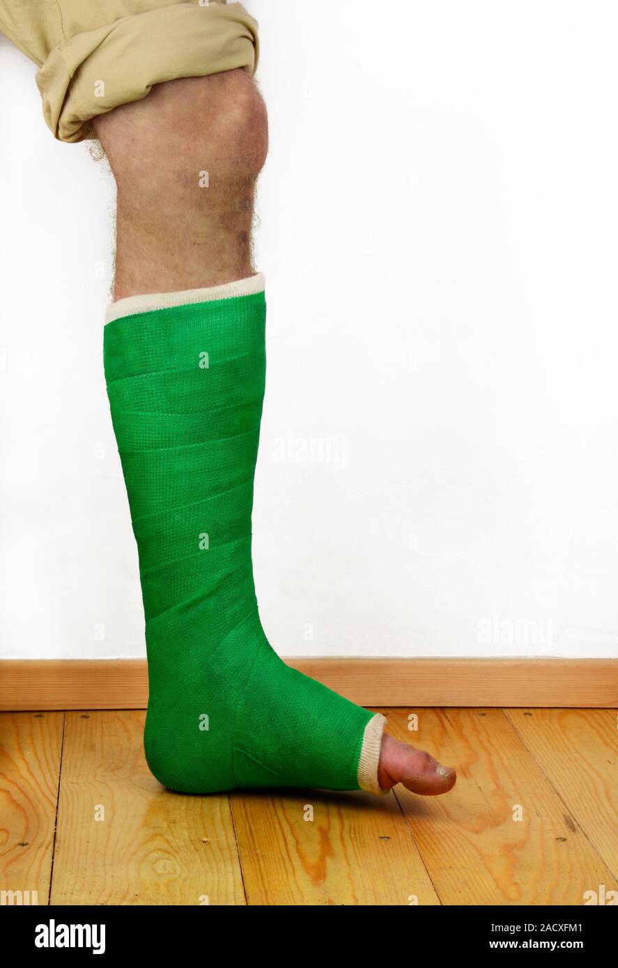 Fractured tibia immobilised in a short cast to allow the bone to heal ...