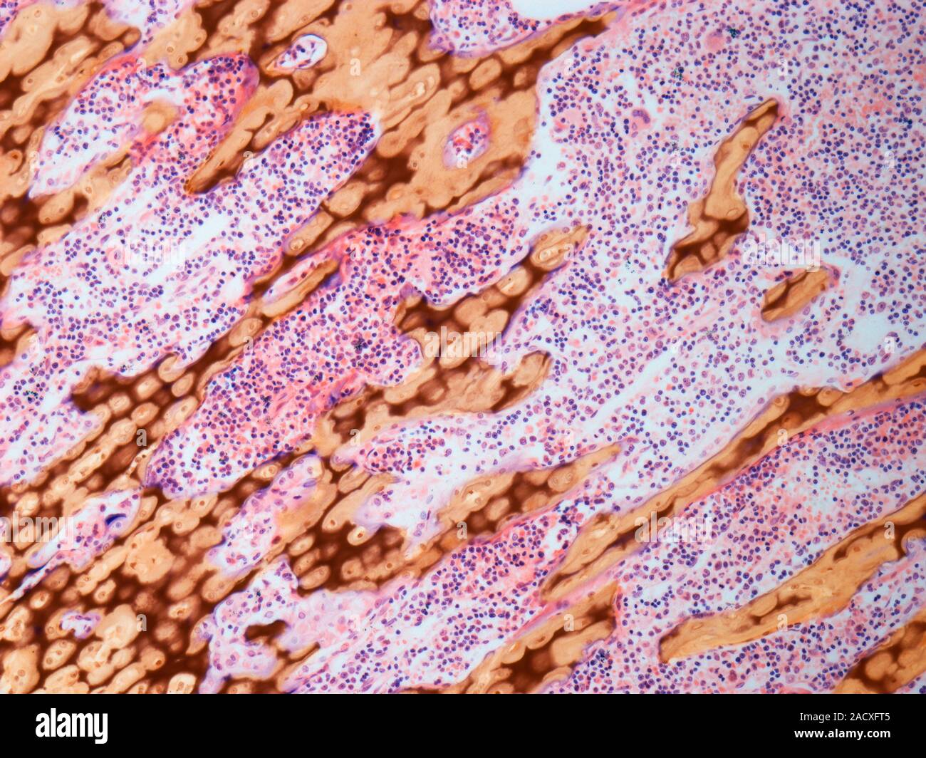 Spongy bone, light micrograph from a section of spongy or cancellous ...