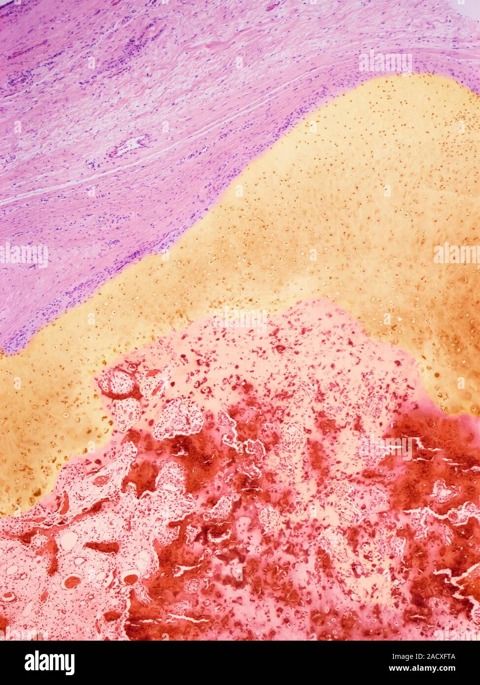 Testicular Cancer Light Micrograph Of A Section Of A Testicular