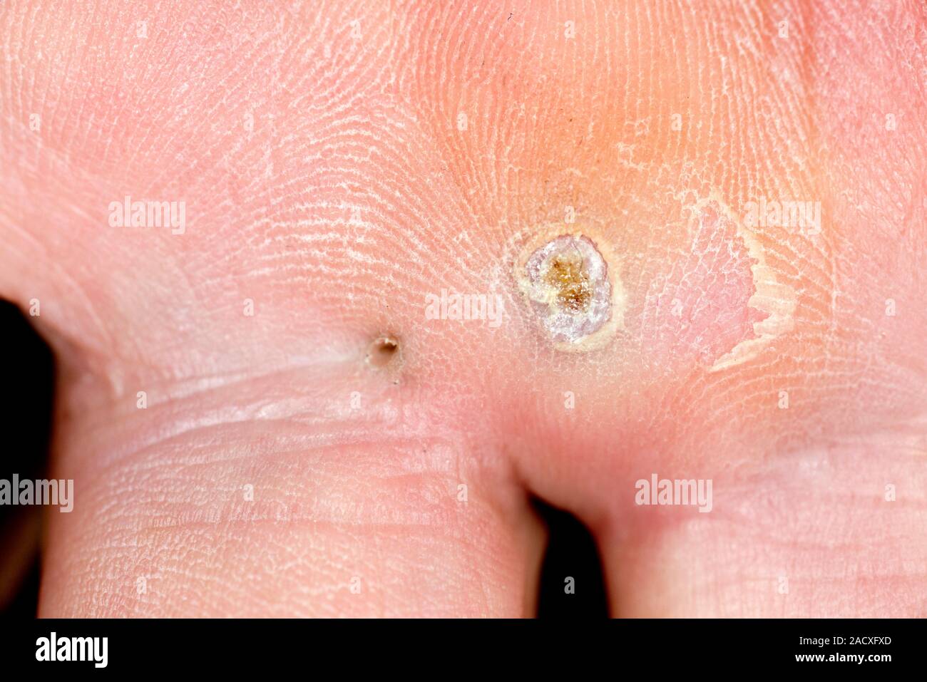 Infection at the site of a splinter on the palm of an 80-year-old man ...
