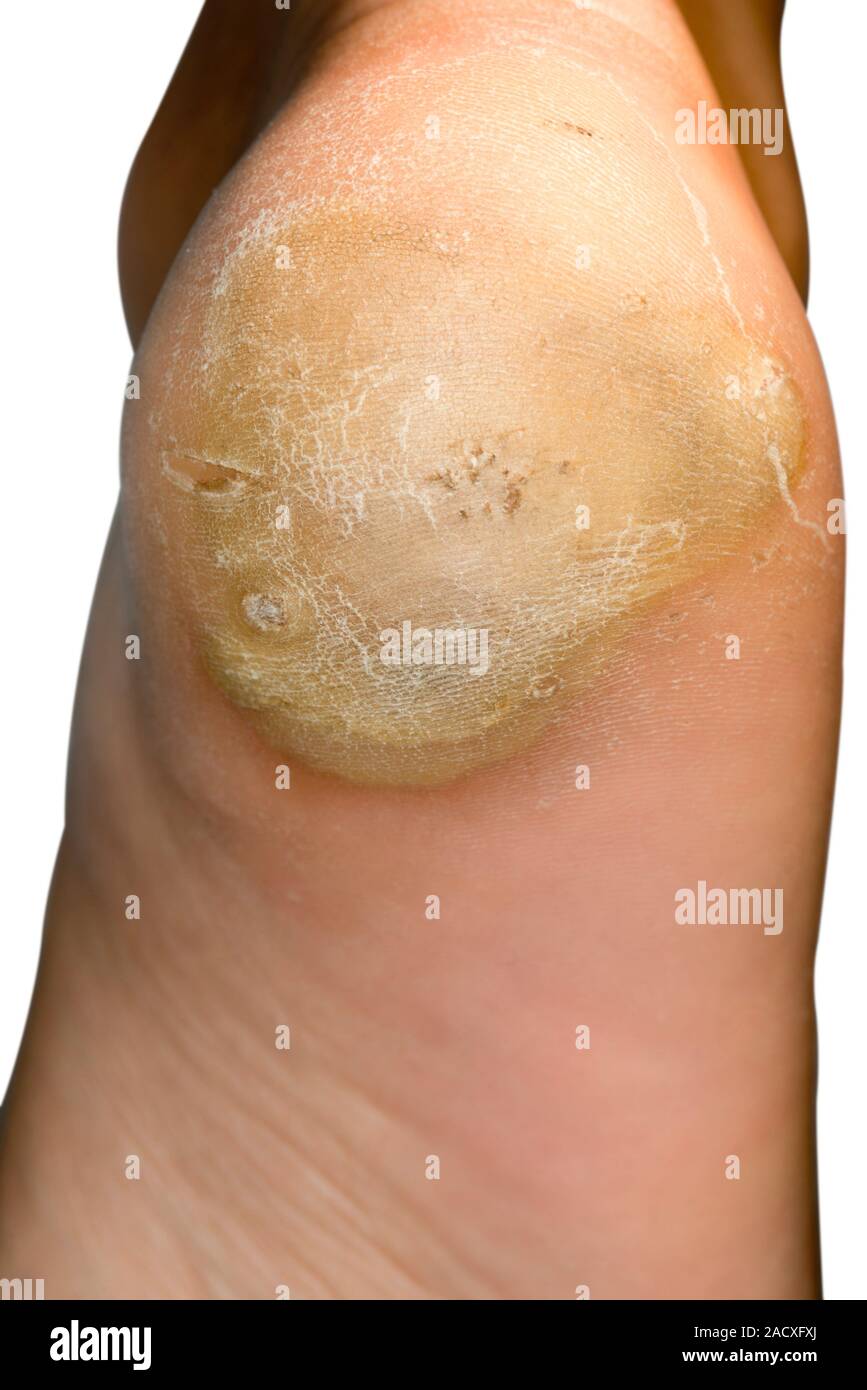 Abscess on a 20-year-old woman's heel. An abscess is a painful pus ...