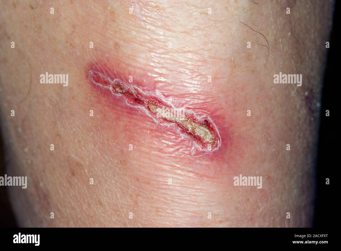 Infected laceration (irregular wound) in the skin of the shin of a 55 year old male patient ...