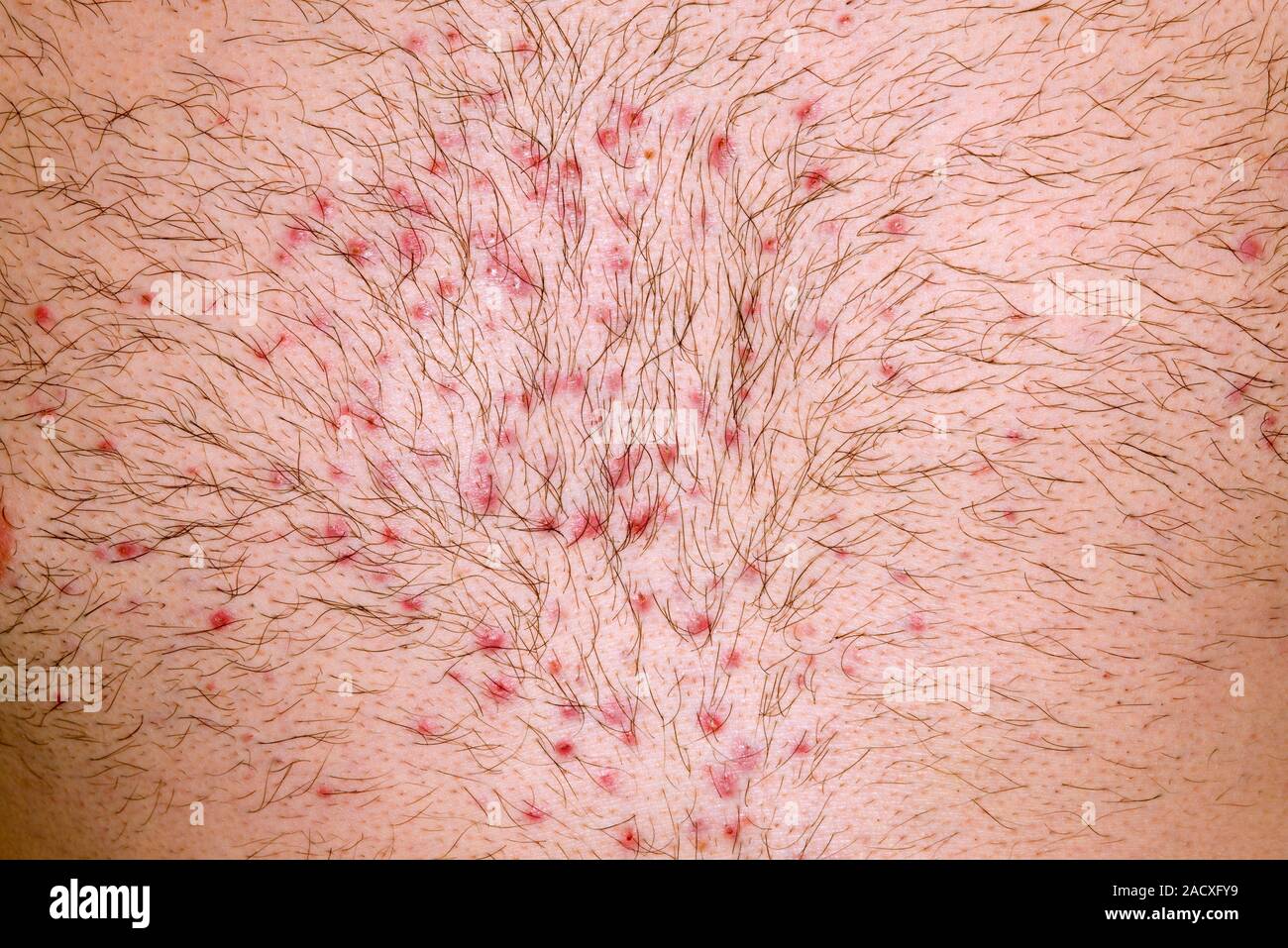 Inflamed hair follicles (red spots) on a 28-year-old man's chest, a ...