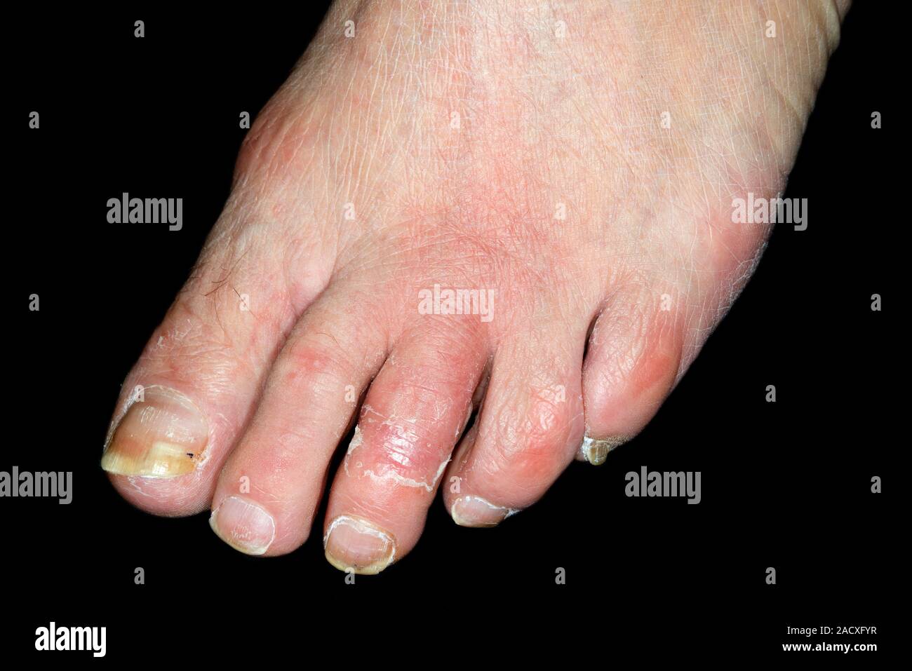Inflammation Of The Toes And Foot Caused By Cellulitis Secondary To Athletes Foot Tinea Pedis
