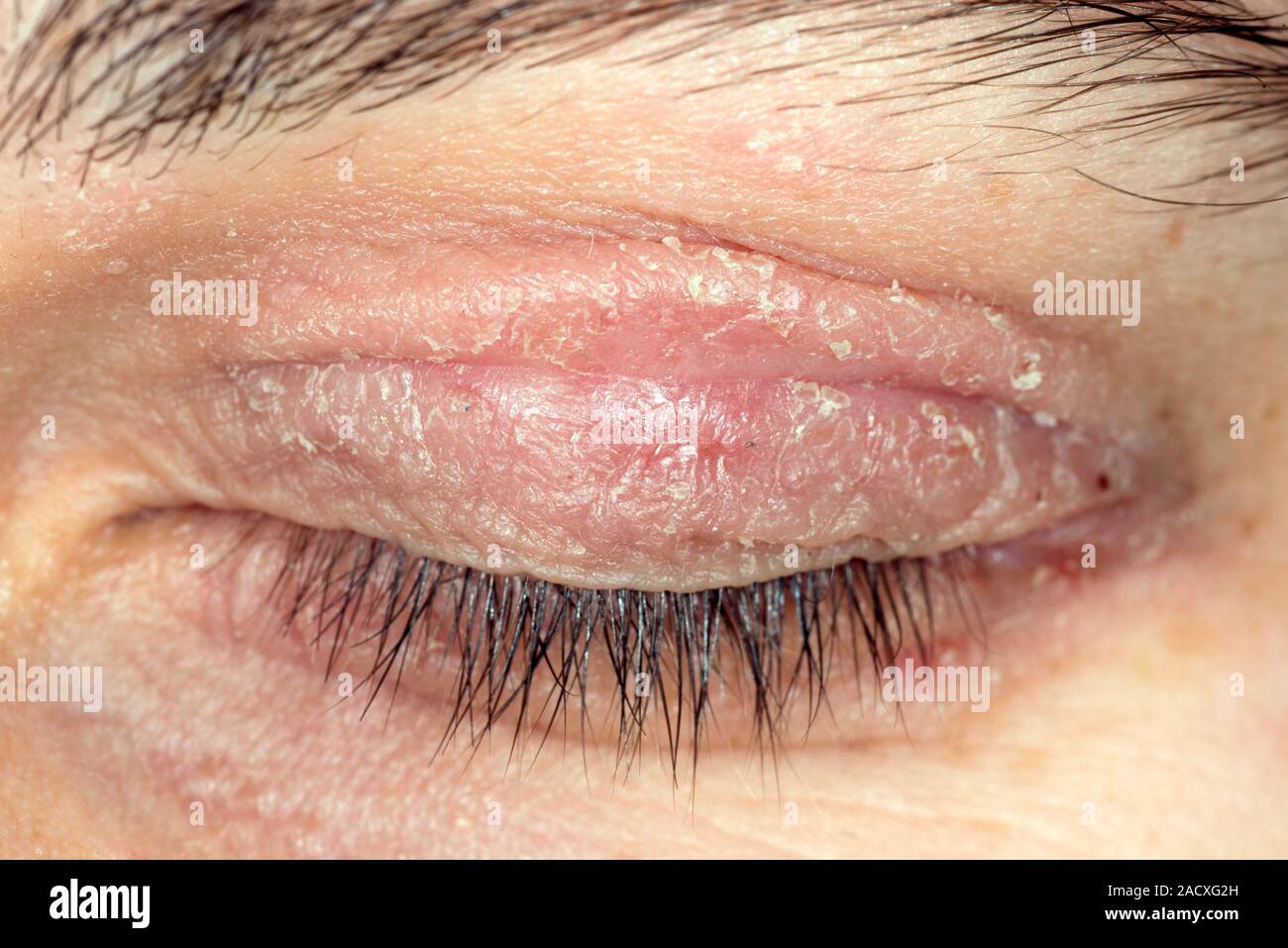 Eyelid Dermatitis Eyelid Dermatitis (xeroderma Of The Eyelids, Eczema