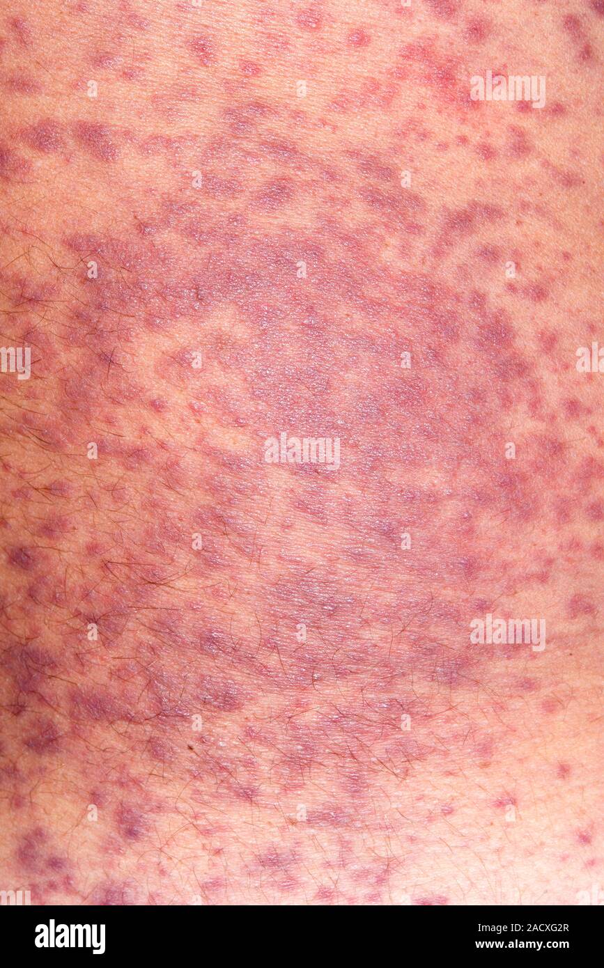 Close up of a rash on the skin of a 52 year old man due to an allergic ...