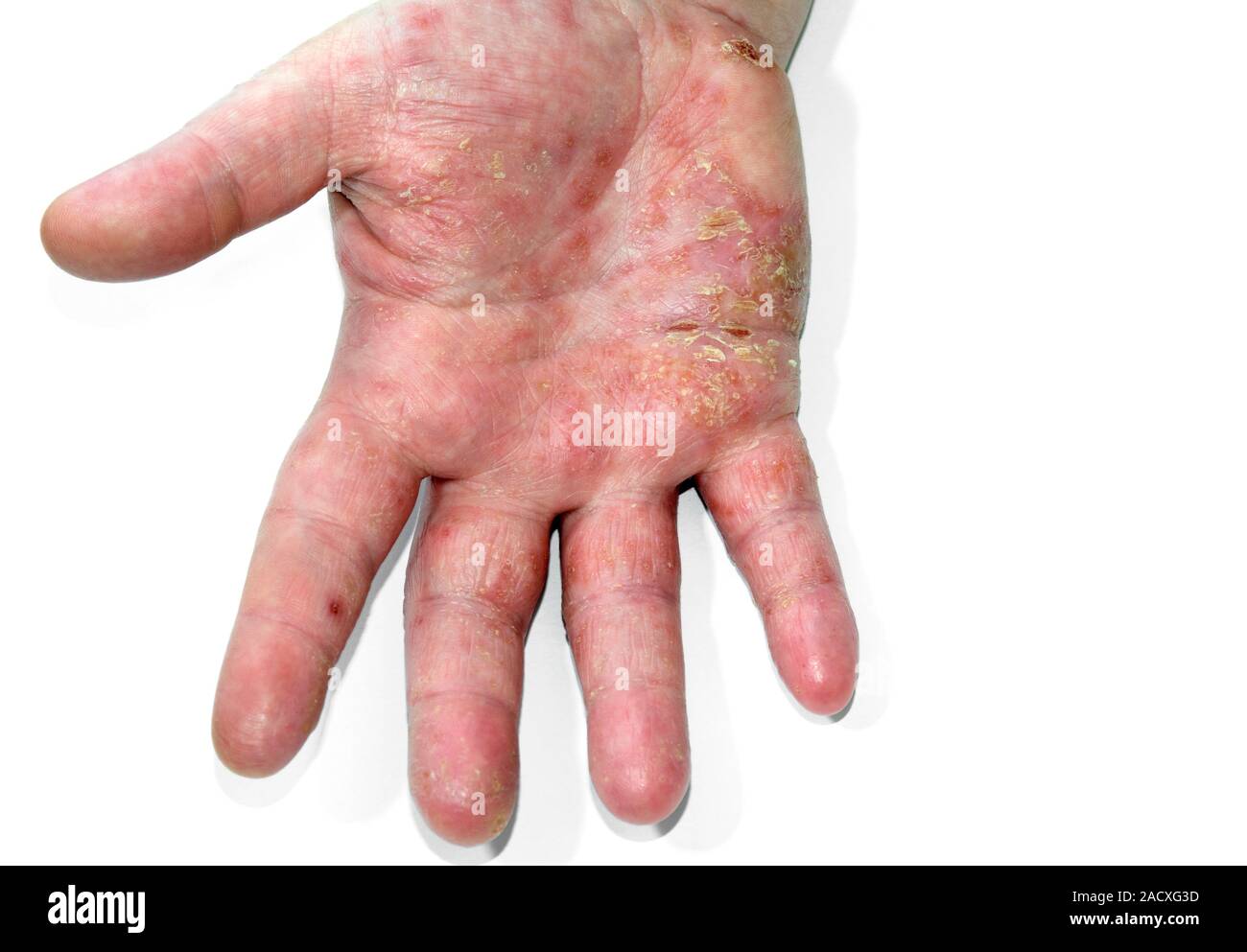 Inflamed and flaking skin on the hand of a 3 year old boy with eczema ...