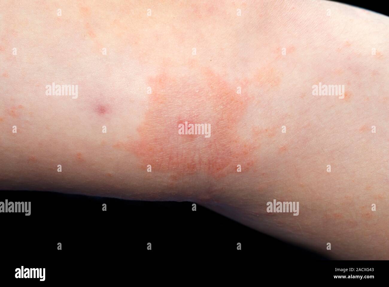Rash of red weals on the skin of a 5 year old girl, an urticarial ...