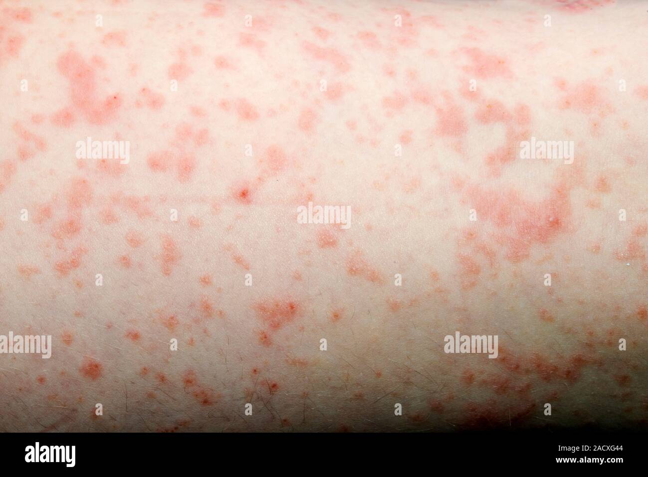 Rash of red spots on the skin of a 5 year old girl, an urticarial ...