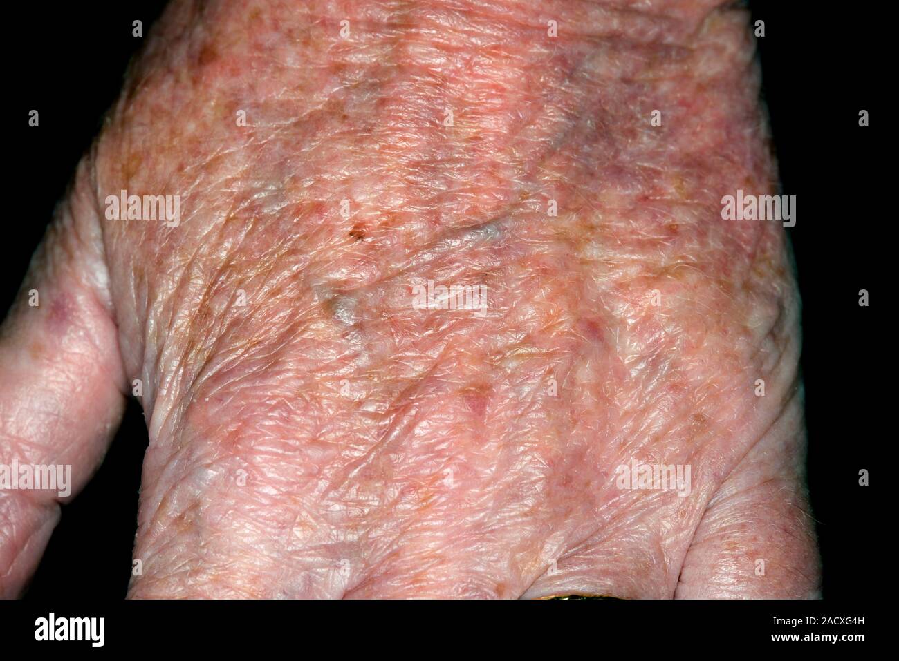 Exfoliative Dermatitis