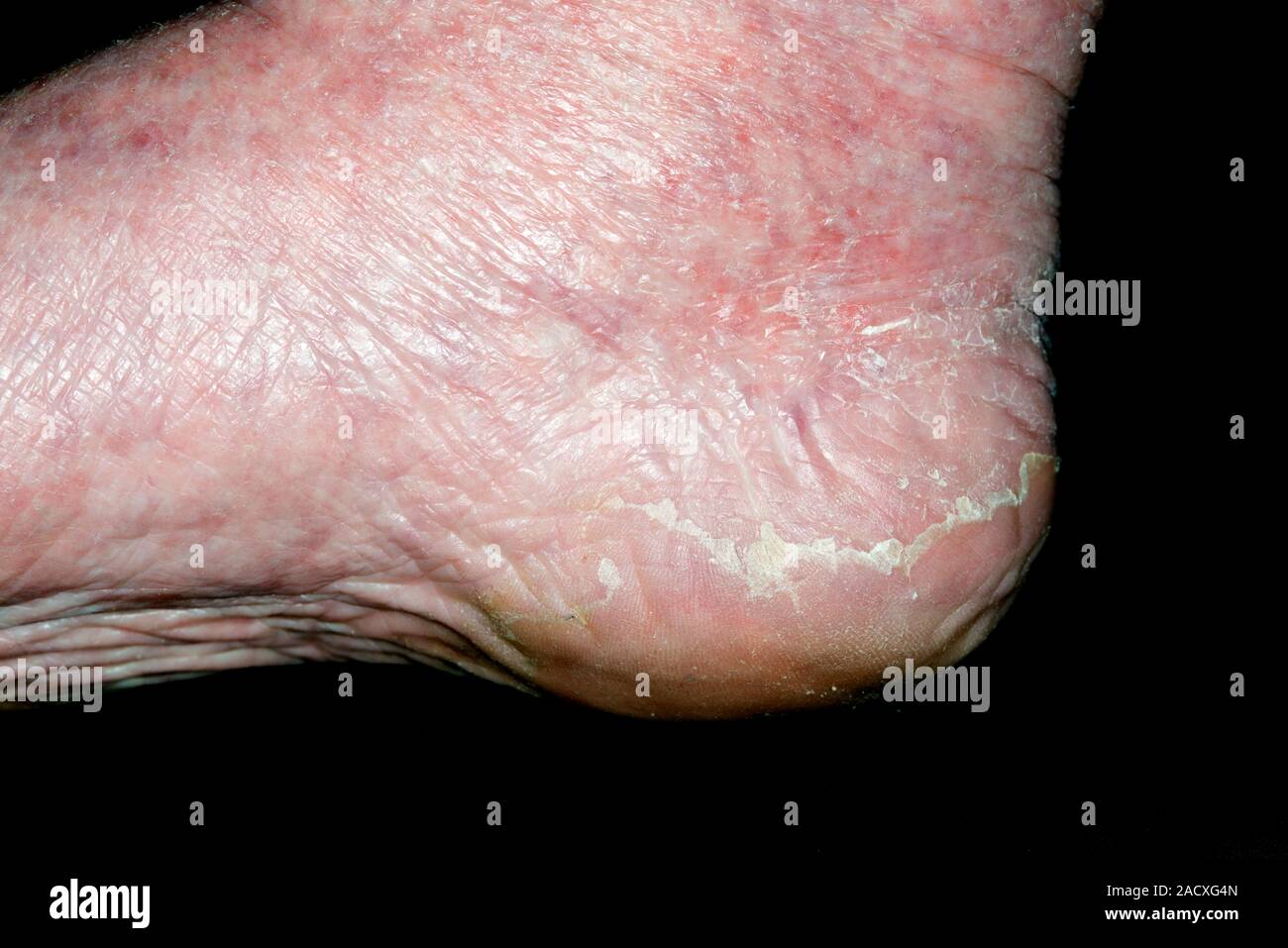 Exfoliatieve Dermatitis 12 Exfoliative Dermatitis Stock Photos,