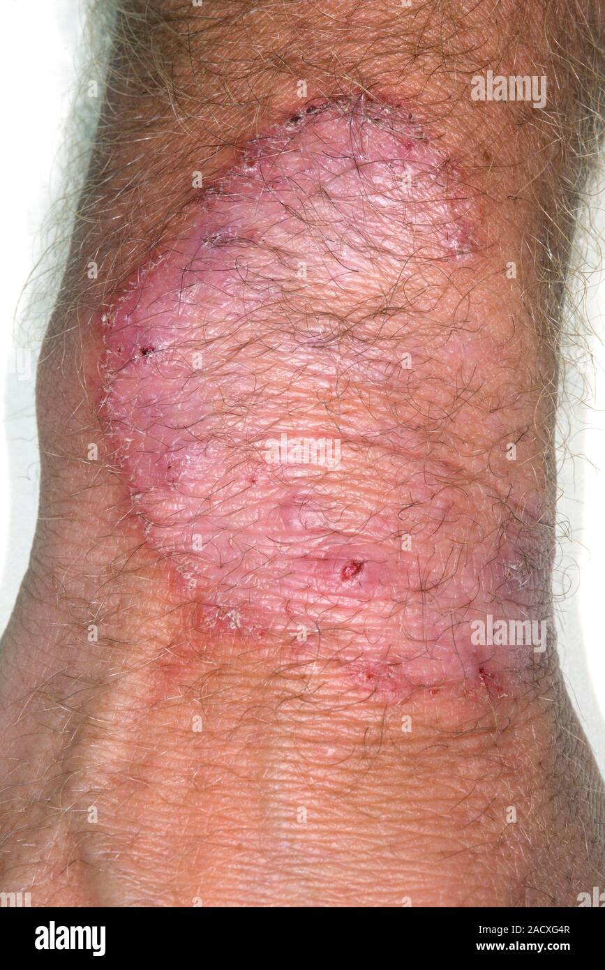 Close-up of the wrist of a 50 year old man affected by tinea, a fungal ...