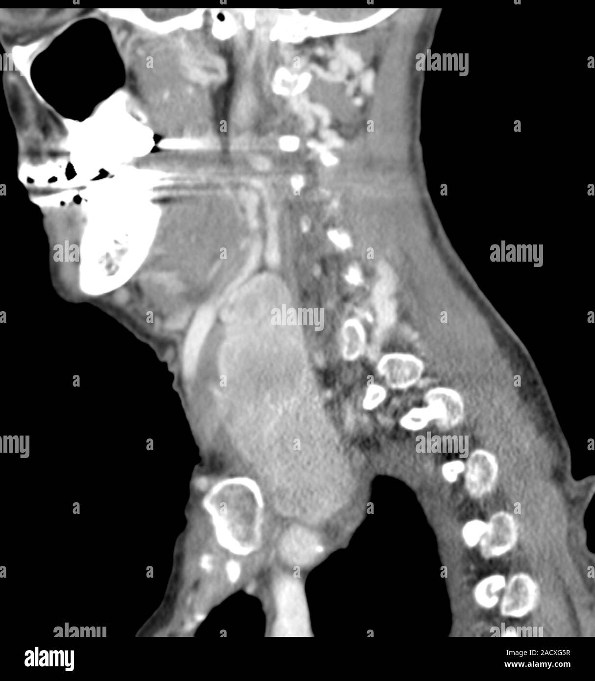 Computed tomography (CT) scan of the neck of a 78 year old female ...