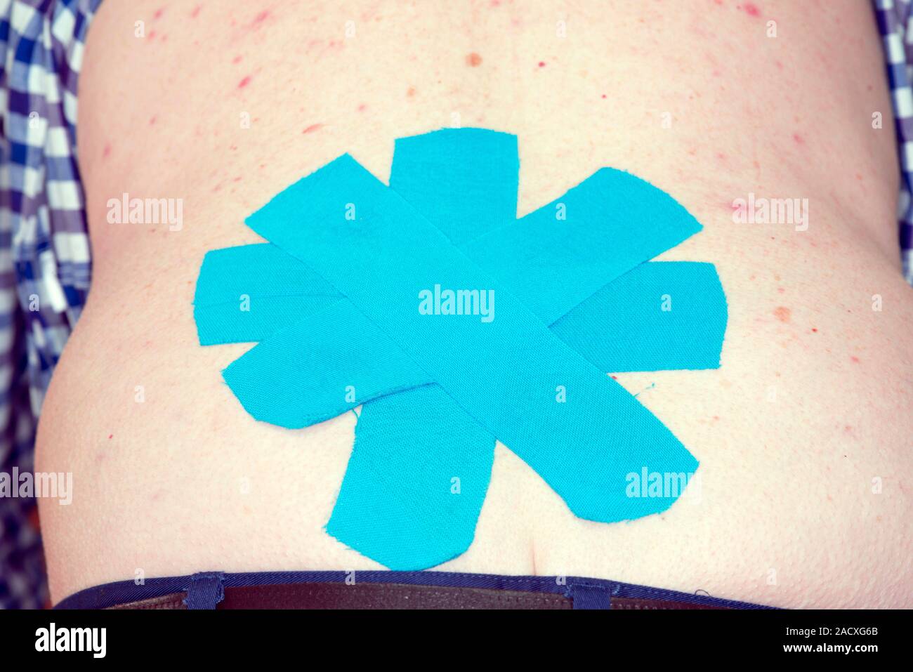 Elastic therapeutic tape over the lumbar spine. This kind of taping is ...