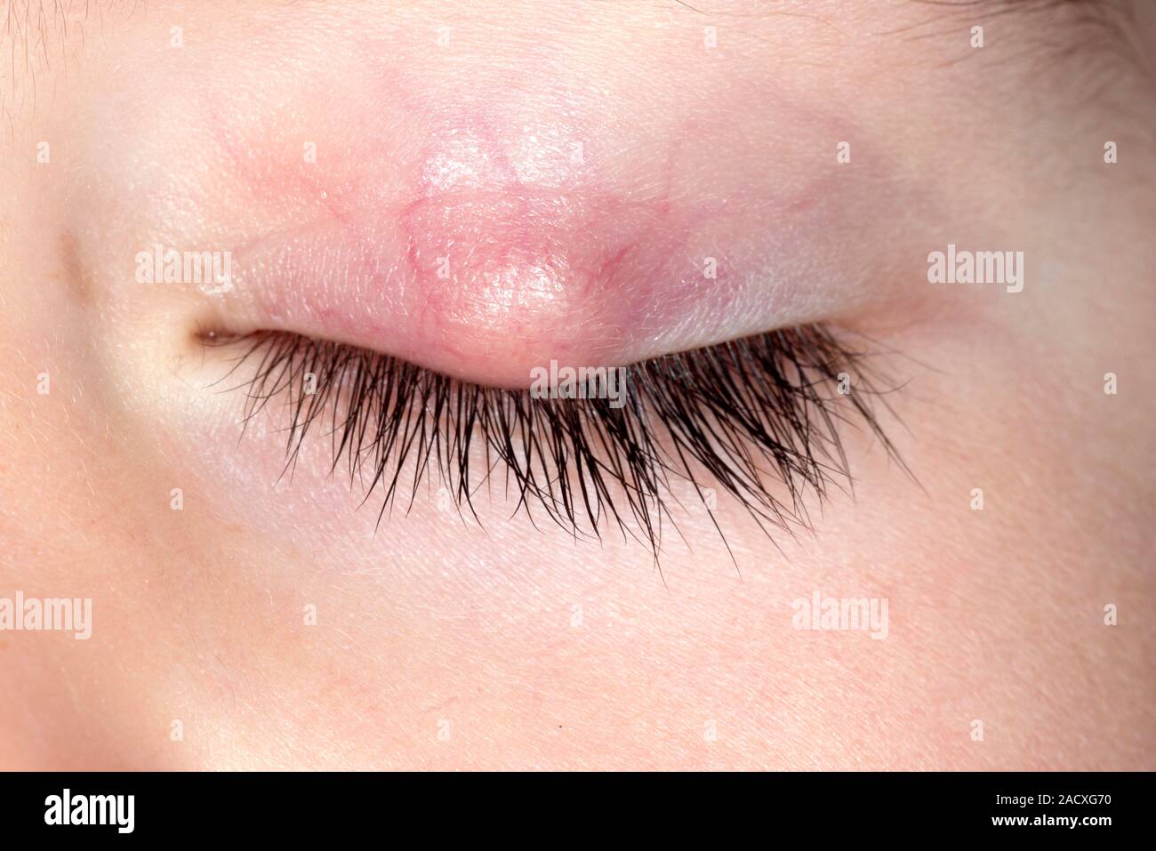 Stye on the upper eyelid of a 4 year old boy. A stye is a bacterial ...