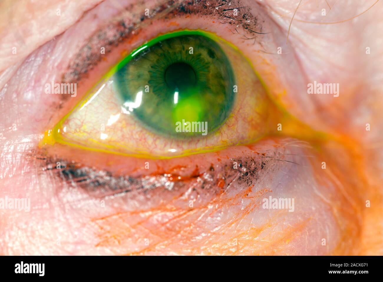 Corneal ulcer (green, just below pupil) on the eye of an 67-year-old ...