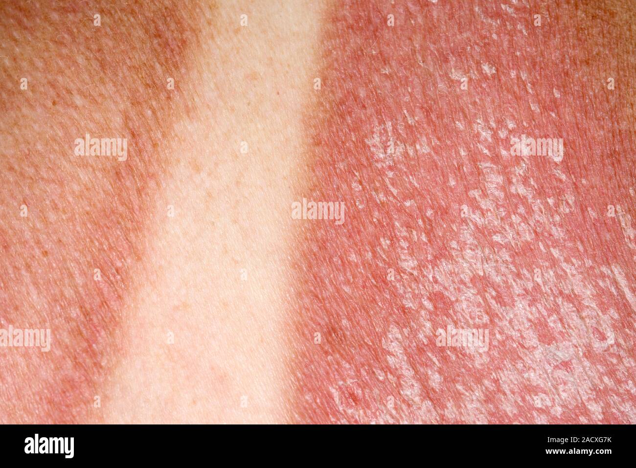Close up of sunburn on the shoulder of a 63 year old woman. On the ...