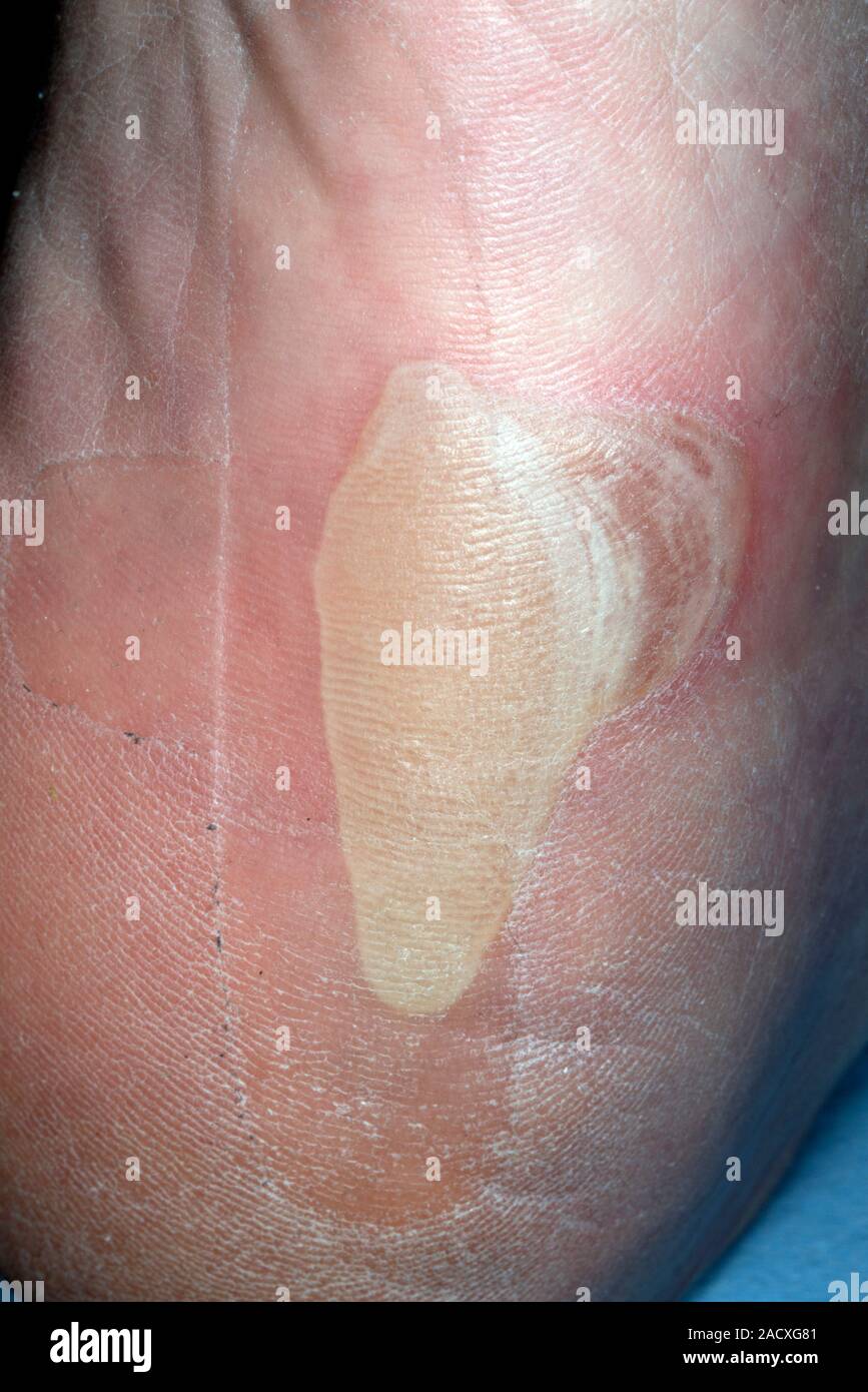 Large blister on the foot of a 70 year old man, caused by new walking ...