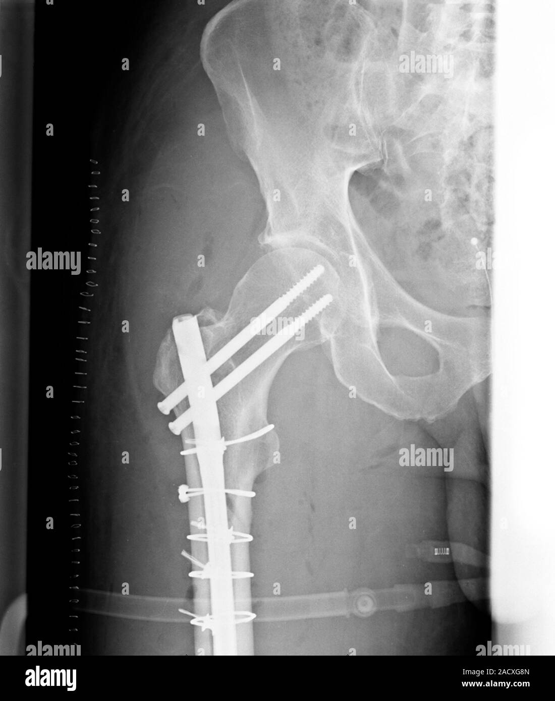 X-ray showing internal fixation, with pins and rod, of a fractured ...
