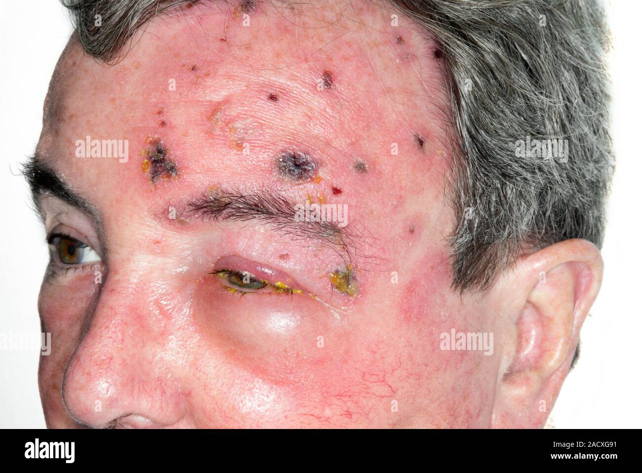 View Of The Face Of A 70 Year Old Man During An Attack Of Shingles Also Known As Herpes Zoster