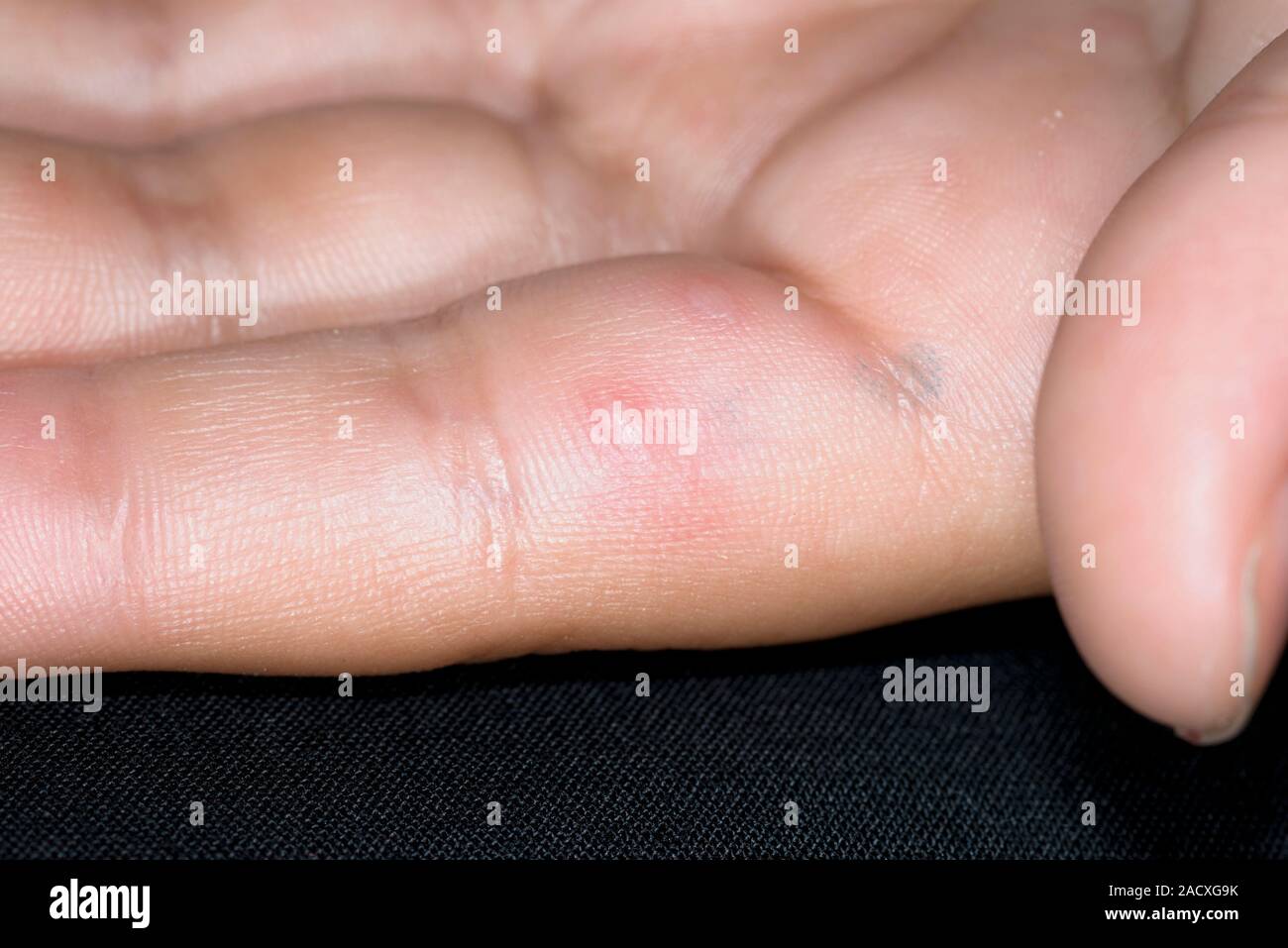 Hand, foot and mouth disease. Close-up of a blisters (known as vesicles ...