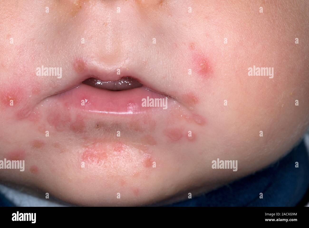 Hand, foot and mouth disease. Rash around the mouth of a 1 year old boy ...