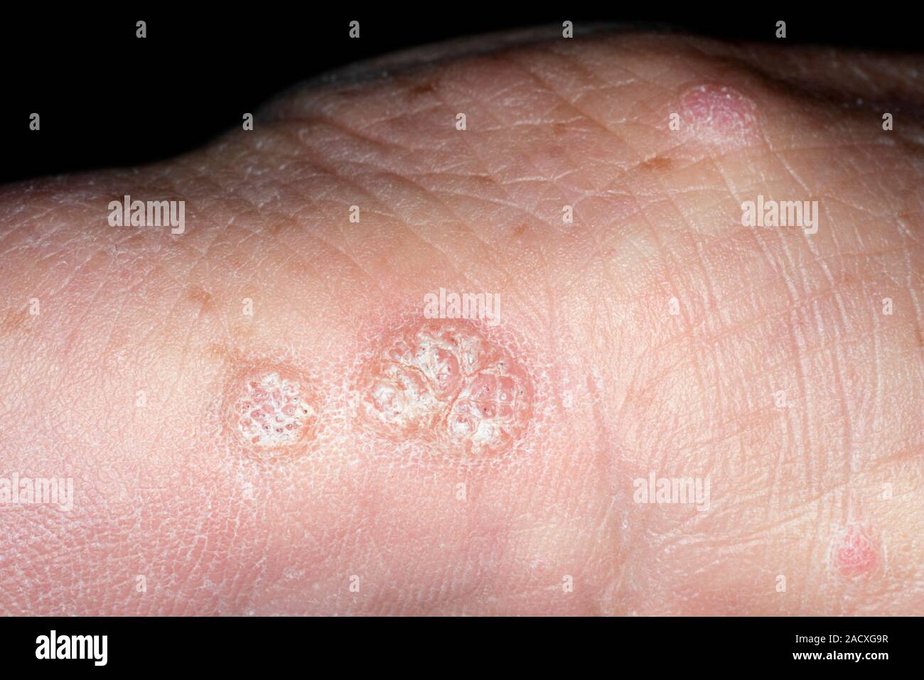 Multiple warts on a 64 year old man's hand. Warts (verrucae) are of ...
