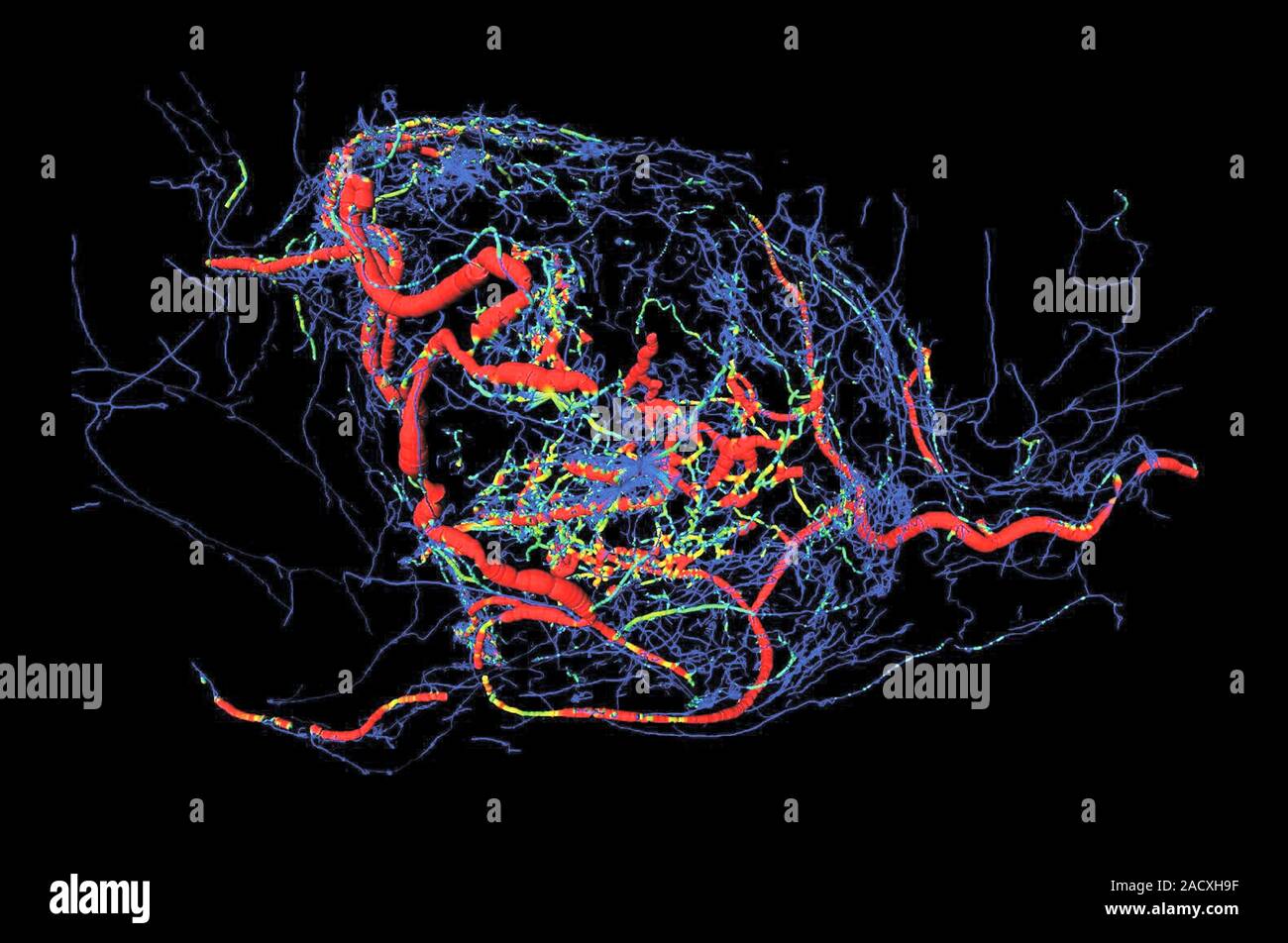 Tumour blood vessels. Coloured 3D computed tomography (CT) scan of ... Tumour blood vessels. Coloured 3D computed tomography (CT) scan of ...