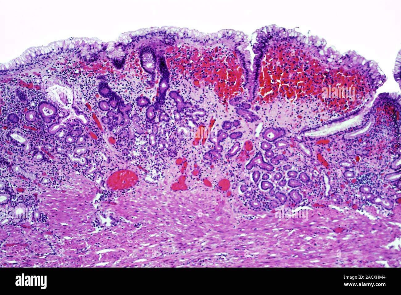 Gastritis. Light micrograph of a section through the lining of the ...