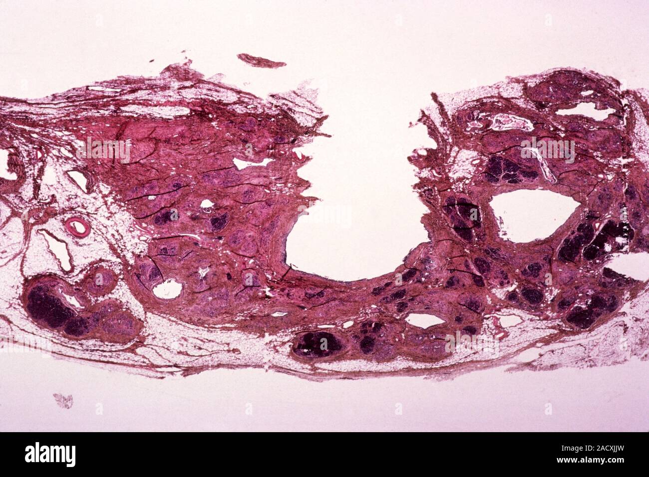 Chronic pancreatitis. Light micrograph of a section through tissue from ...