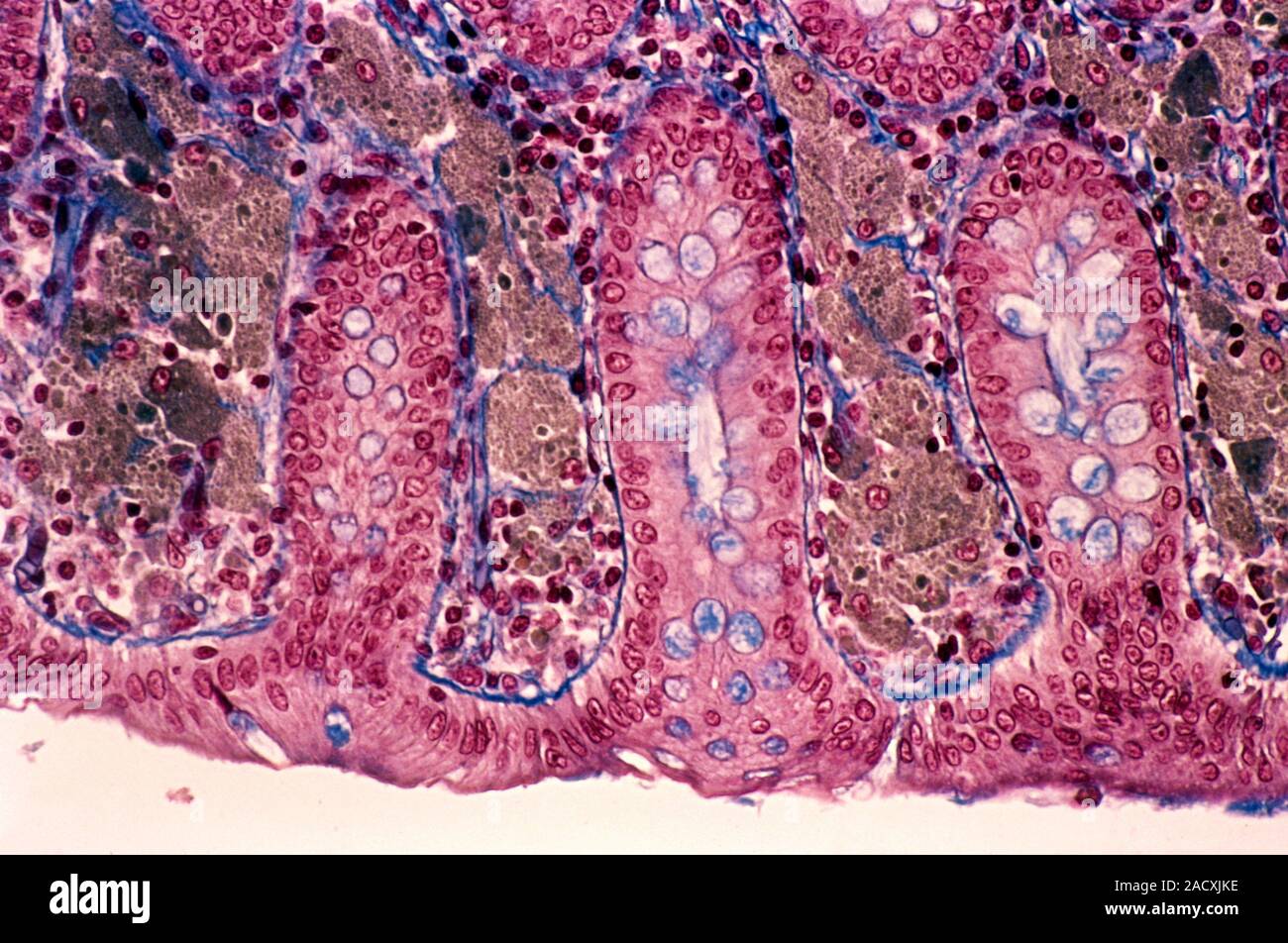 Melanosis coli. Light micrograph of a section through the colon (large ...