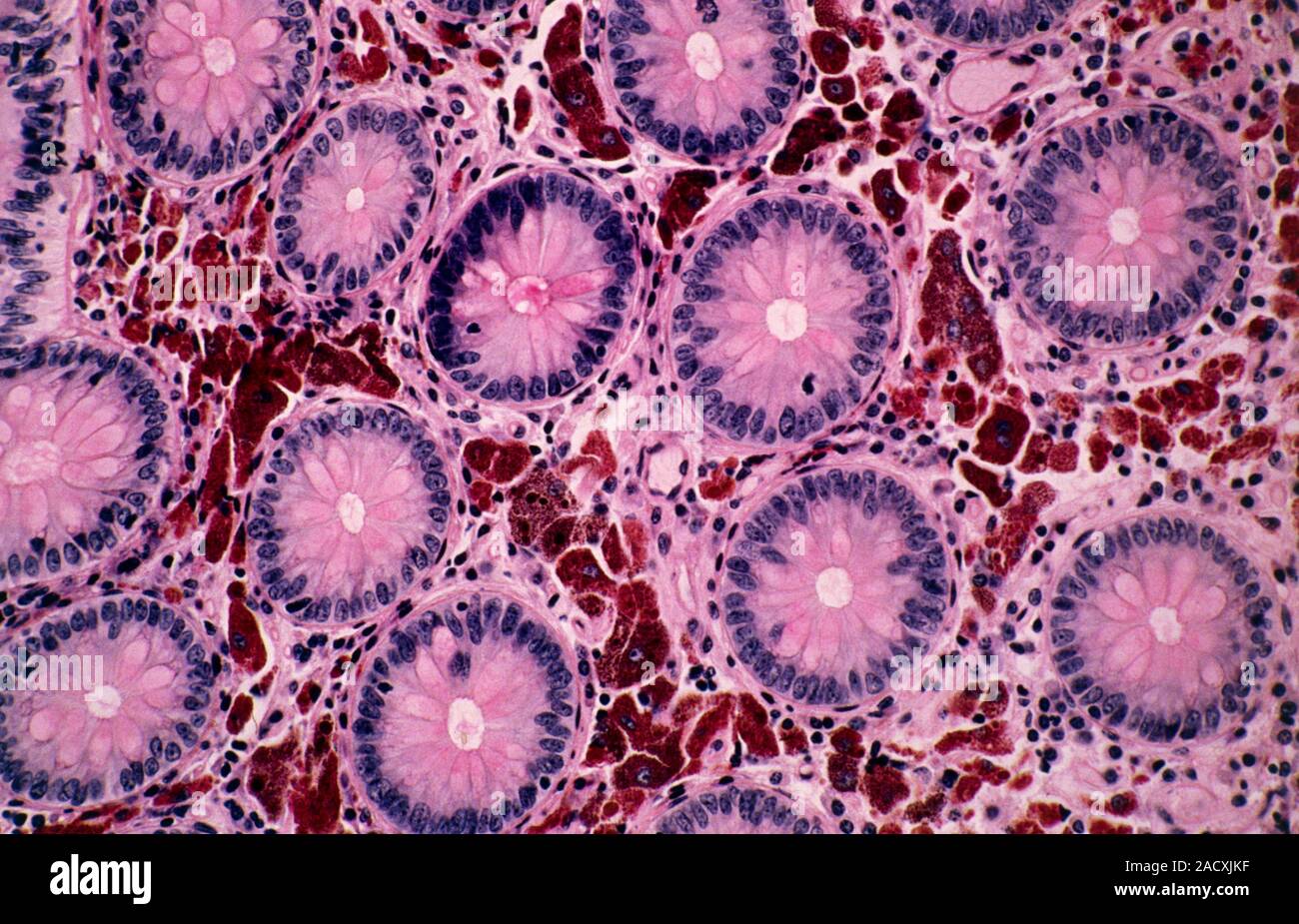 Melanosis coli. Light micrograph of a section through the colon (large ...