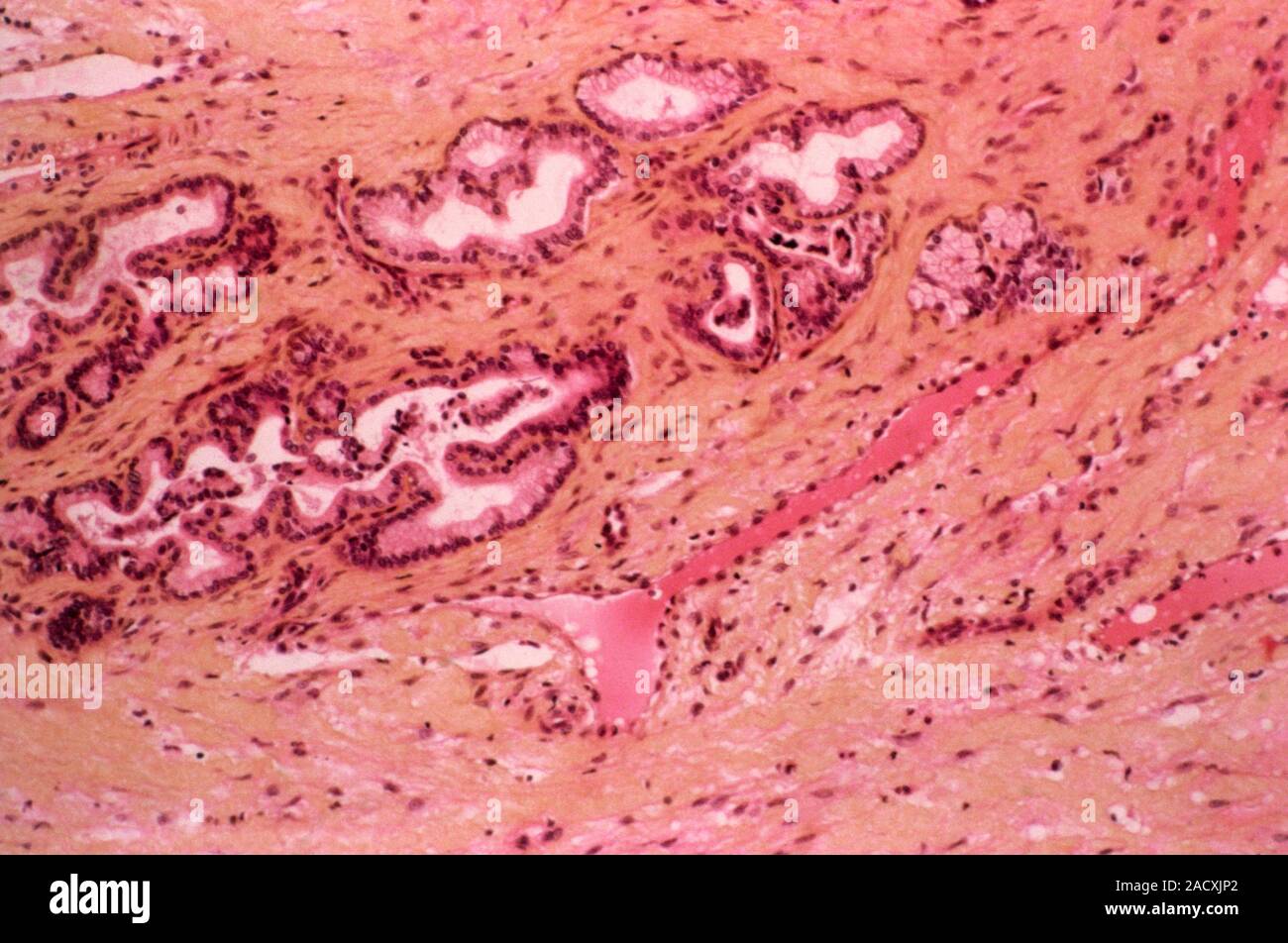 Stomach metaplasia. Light micrograph of a section through tissue from ...