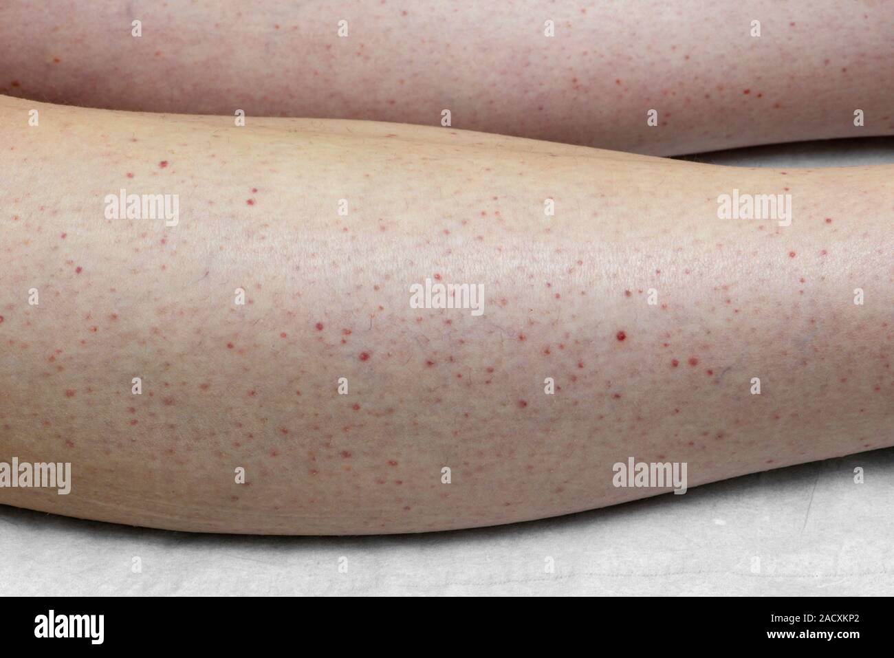 Not for use in Television Not for use in Television Henoch-Schonlein ...